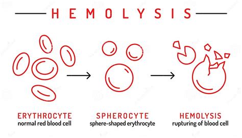 Hemolytic Anemia Infographic Vector Illustration Isolated On A White