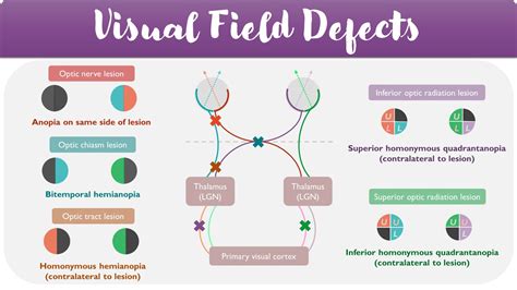 quadrantanopia visual field defect medbullets on x contralateral