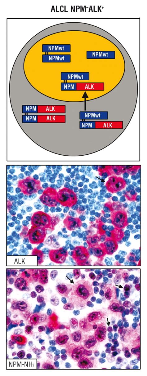 Translocations And Mutations Involving The Nucleophosmin Npm1 Gene In