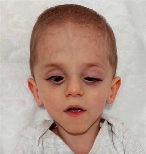 American Journal Of Case Reports Bartter Syndrome Presenting As