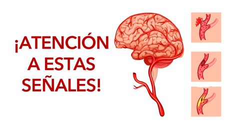 Que Es Un Derrame Cerebral