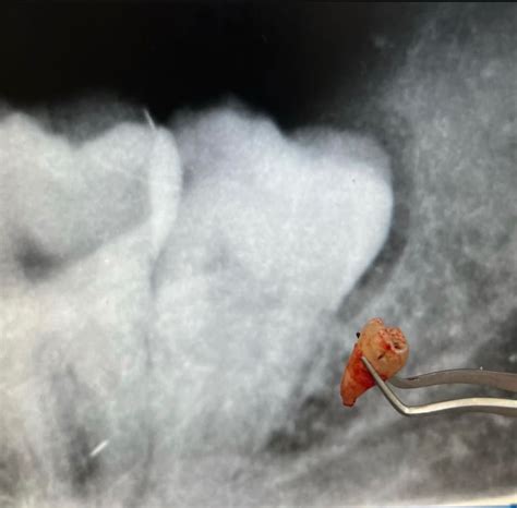 Dr Irfanullah Alwani On Linkedin 3rd Molar Disto Angular Impaction