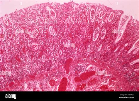 Ulcerative Colitis Light Micrograph Of A Section Through A Colon Affected By Ulcerative Colitis