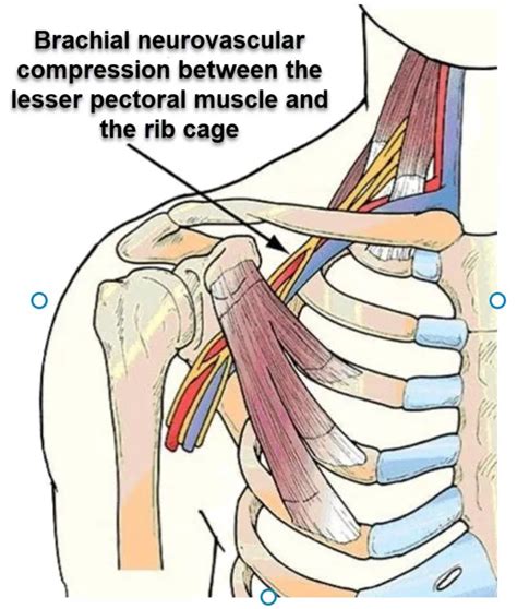 Revolutionizing Thoracic Outlet Syndrome Diagnosis And Treatment In Th