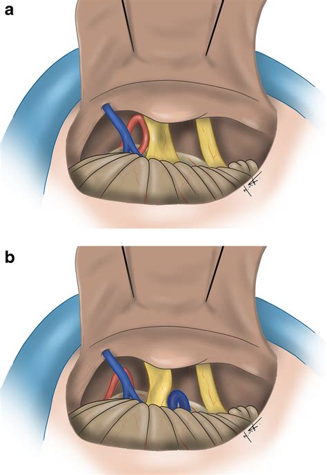 Illustration Depicting An Arterial Compression Of The Trigeminal Nerve Download Scientific