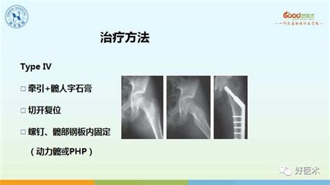 今日公开课儿童股骨颈骨折的分型及治疗策略 上海开为医药科技有限公司 创伤肢体矫形技术解决方案的专业服务商