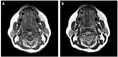 Type Of Magnetic Resonance Images Acquired For The Study A
