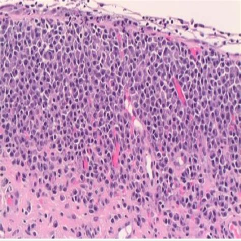 Histopathology Showing Finding Suggestive Of Malt Lymphoma With