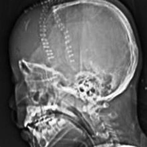Modified Bifrontal Craniotomy Download Scientific Diagram