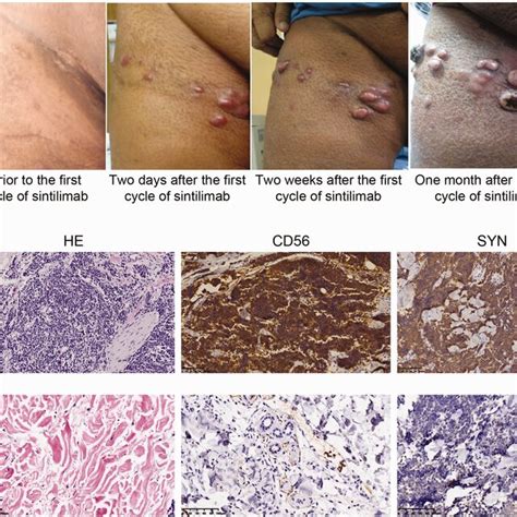Hyperprogression After Immunotherapy In A Patient With Merkel Cell