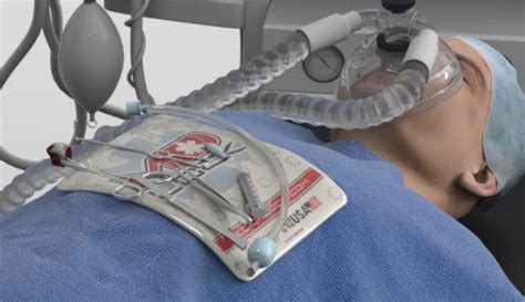 Surgilock Breakthrough Surgical Platform