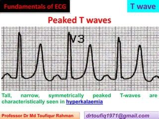 Approach To A Patient With T Wave Abnormality In ECG PPSX Heart And Cardiovascular Diseases