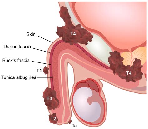 Penile Cancer Staging