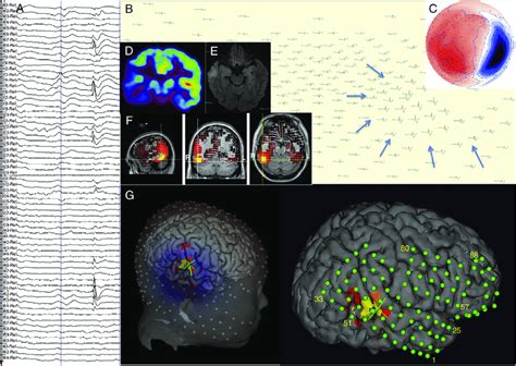 Case No 7 A Interictal Epileptic Discharges Recorded By Iceeg Are Download Scientific Diagram