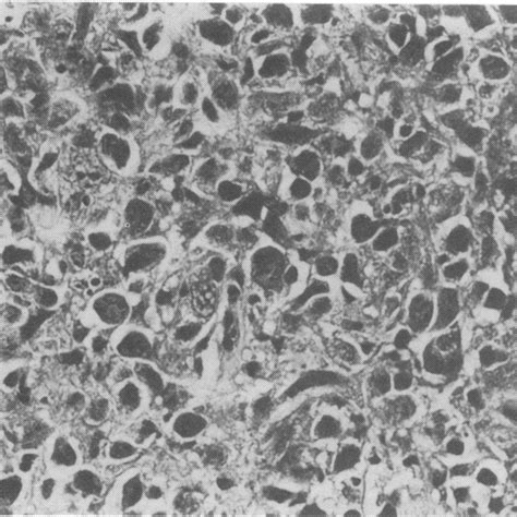 Needle Biopsy Specimen Of Left Adrenal Showing Large Malignant Cells