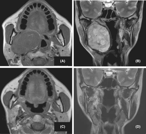 Mr Imaging Of Case 1 A Preoperative T1‐weighted Horizontal Section