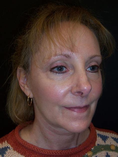 Before After Brow Lift Procedures In Rancho Santa Margarita CA