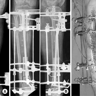 A The Patient Showed A Large Tibial Bone Loss With The Insertion Of Download Scientific
