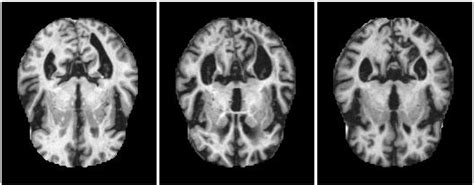A Two Step Approach For Classification In Alzheimers Disease
