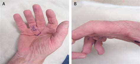 Finger Flexion