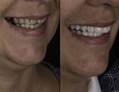 Smile Makeover Dentist Cape Town Dr Jj Serfontein