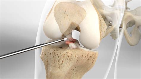 Acl Reconstruction In India Cost Faqs Process