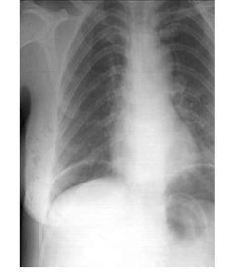 Plain X Ray Of The Abdomen With Air Under Diaphragm Download