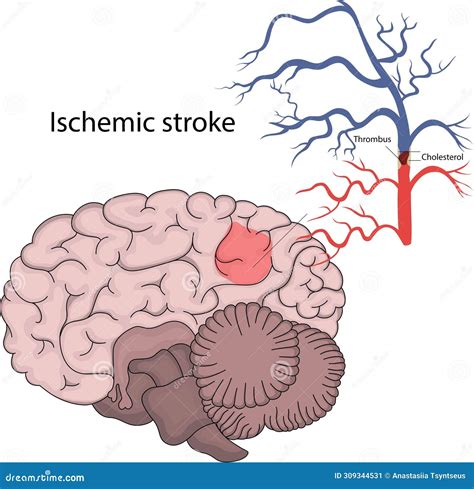 Vector Illustration Of Ischemic Stroke Brain Infarction
