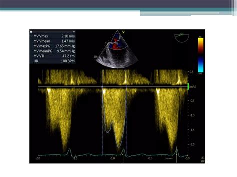 Mitral Stenosispptx