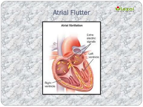 PPT Atrial Flutter PowerPoint Presentation Free Download ID 7927247