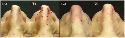 An Innovative Approach For Nasal Reshaping Using Hyaluronic Acid