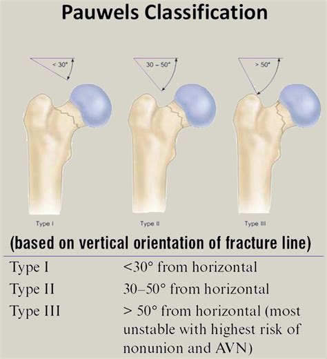Garden Classification Of Hip Fractures Radiology Refe