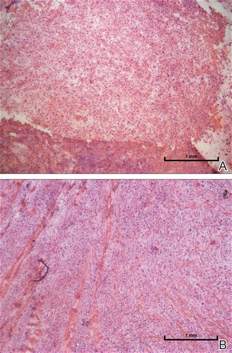 Intravascular Involvement Of Cutaneous Squamous Cell Carcinoma Mdedge