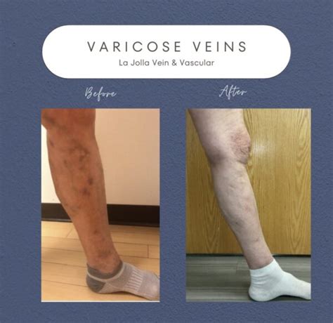 Vein Mapping Ultrasound Vein Mapping In Vascular Health