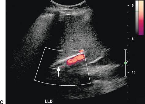 Normal Portal Vein Flow Ultrasound