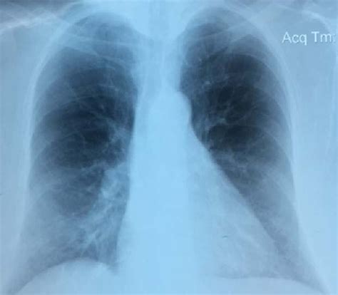 Posteroanterior Chest X Ray Reticular Net Like Shadowing Of The Lung