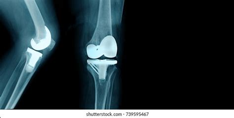 Xray Image Total Knee Arthroplasty Stock Photo Shutterstock