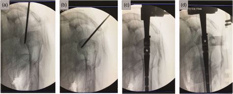 Typical Intraoperative Radiography Showing The Reduction During Surgery