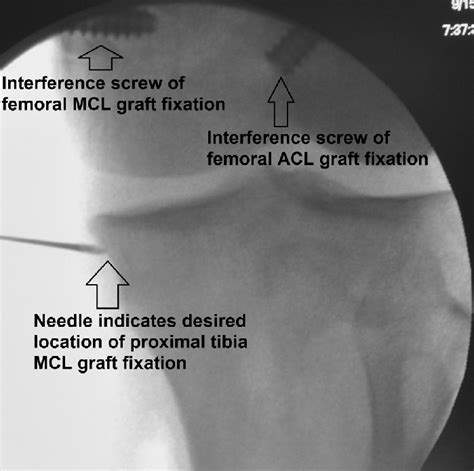 Fluoroscopy In A Left Knee Confirms The Location Of A 21 Gauge Needle