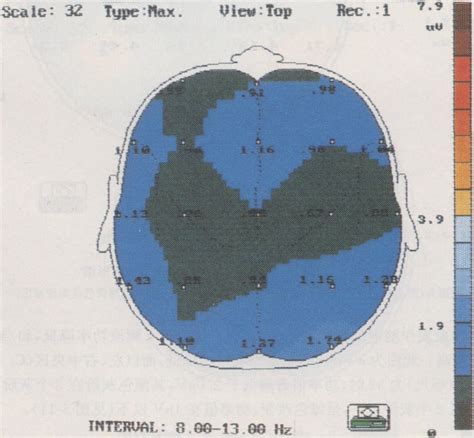 图5 12 脑动脉硬化 Cerebral atherosclerosis 脑电地形图 脑电地形图学