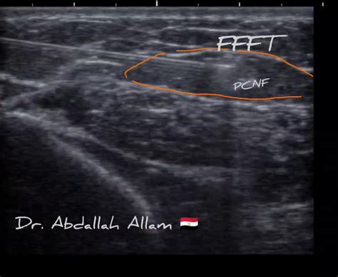 Painlessregenerativemedicine Commonextensortendinopathy