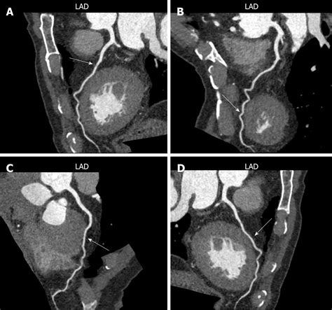 Myocardial Bridge