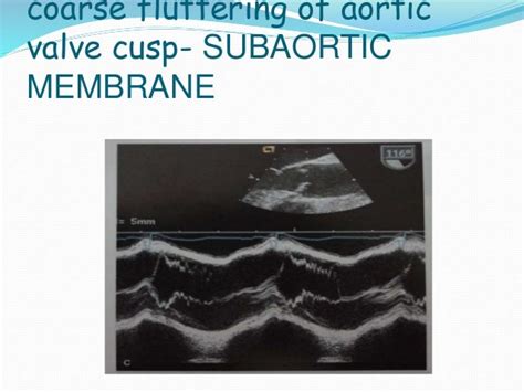 M Mode Echo