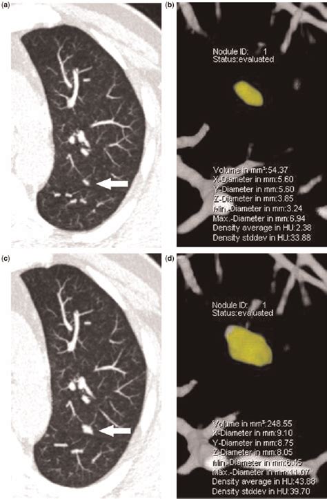 New Pulmonary Nodule In The Apicoposterior Segment Of The Left Superior Download Scientific