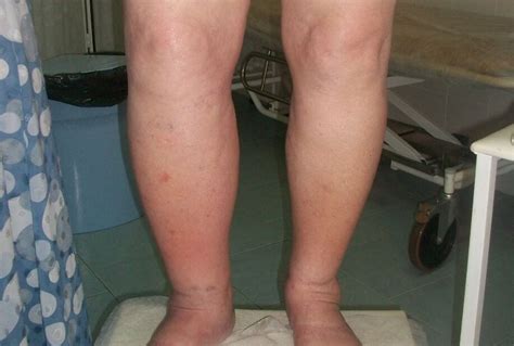 DVT Symptoms Calf Pictures Symptoms And Pictures