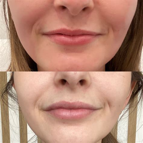 Lip Flip Vs Lip Filler Which Lip Treatment Is Best