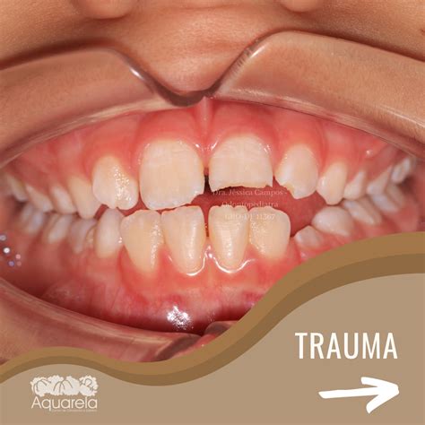 Trauma Dentário Aquarela Odontologia Brasília