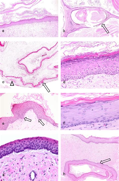 Keratinized Stratified Squamous Epithelium Semantic Scholar