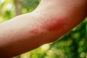 How To Get Rid Of Poison Ivy Without Killing Other Plants