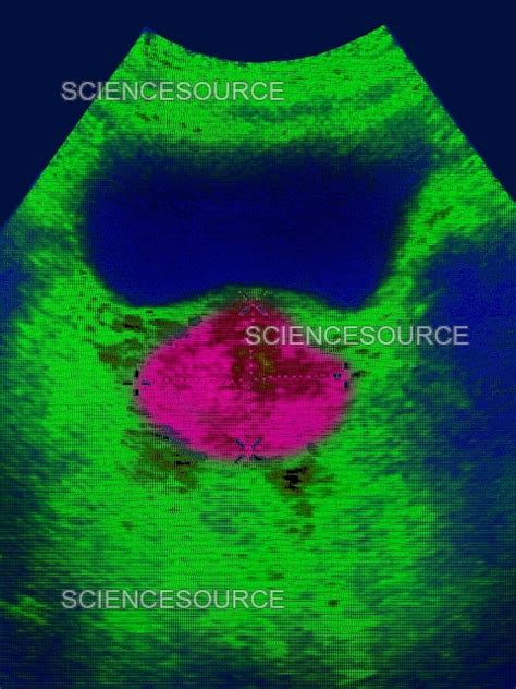 Prostate Ultrasound Stock Image Science Source Images